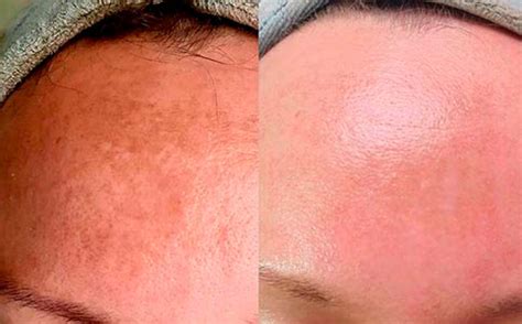 Biorepeelcl3 Aesthetic Medicine And Semi Permanent Makeup Preston