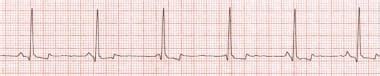 Atrioventricular Dissociation Background Pathophysiology Etiology