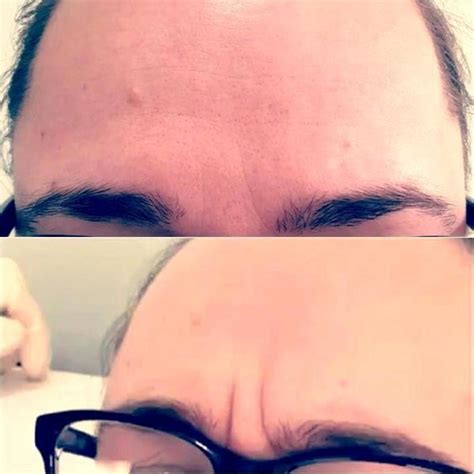 Frown Lines Botox Before And After Facial Injections Info Prices Photos Reviews Q A