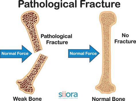 What Do You Need To Know About Pathological Fractures Orthopedic