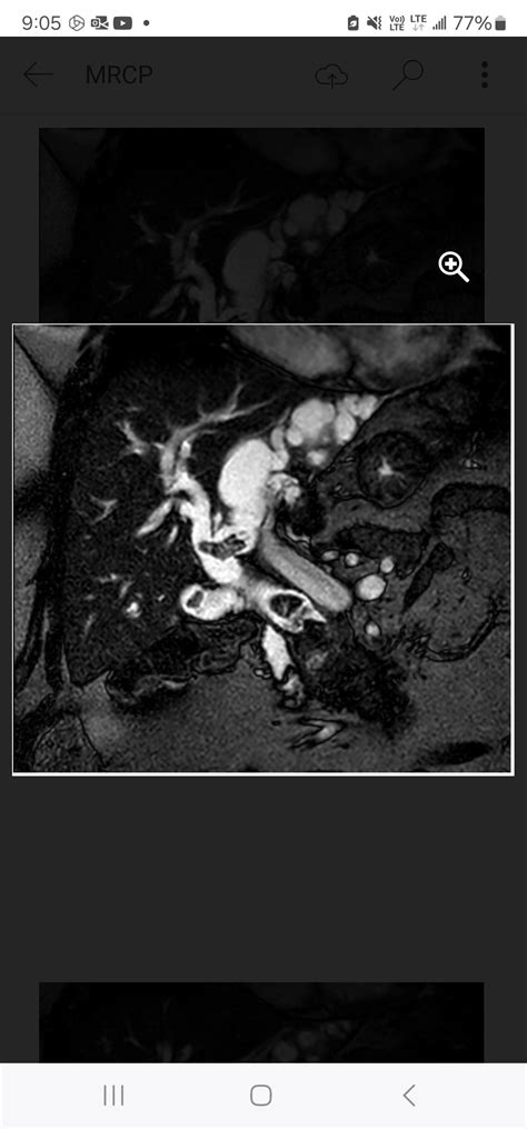 Jiksa Dabessa On Linkedin Ercp For 51 M Admitted For Oj 2ry Choledocholelithiasis Precut…