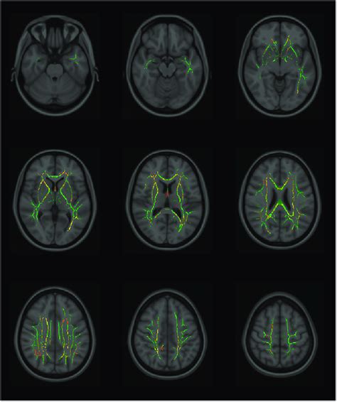 The Tract Based Spatial Statistics Tbss The Tract Based Spatial Download Scientific Diagram