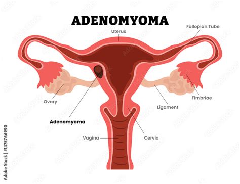Adenomyosis Focal Adenomyoma Diffuse Female Reproductive System Educational Medical Poster