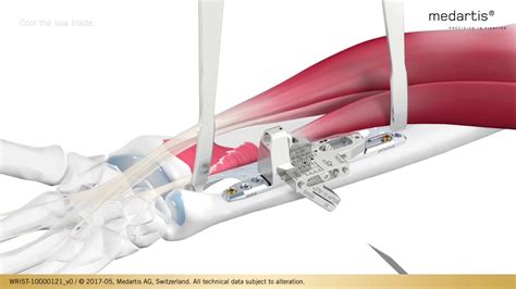 What Is Ulnar Surgery At Jared White Blog