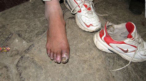 What To Know About Frostbite The Symptoms And How To Treat It Cnn