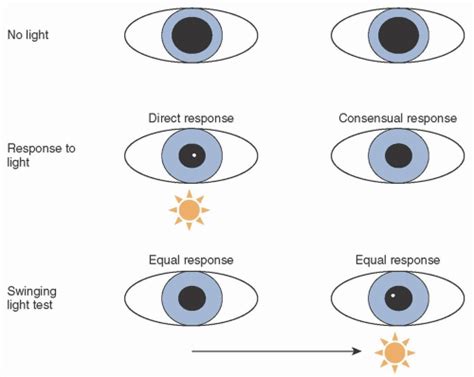 Abnormal Vision Pupils And Eye Movements Anesthesia Key