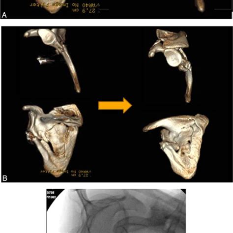 A Computerized Tomography Ct With Three Dimensional 3d Download Scientific Diagram