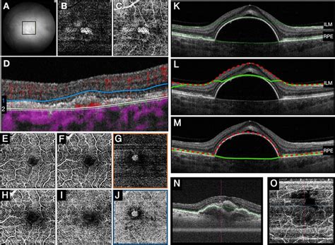 Segmentation Of Cnvm From 3 × 3 Mm Oct A Scan A Fundus Ir Image With Download Scientific