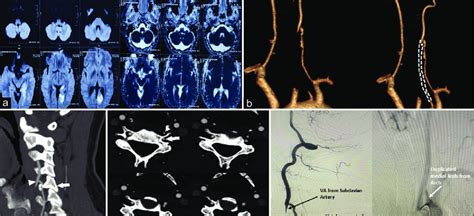 A Mri Brain Showing Restricted Diffusion In Left Pca Territory Download Scientific Diagram