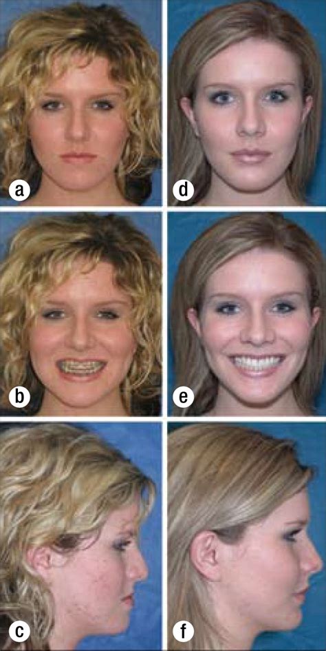 Surgical Management Of Mandibular Condylar Hyperplasia Type 1 Pmc
