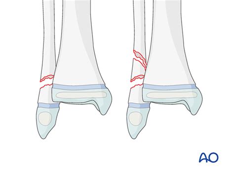 Complete Fractures Of The Distal Fibular Metaphysis