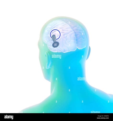 Link Neuralink New Artificial Intelligence Technology That Allows You