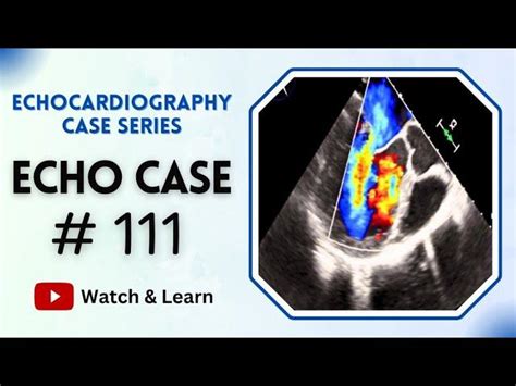 Learn Cardiology On Linkedin Echocardiography Case 111 Echocardiogram Interpretation Made