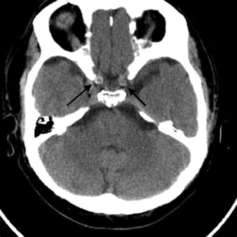 Calcifications On A Coronal Ct Slice In The Internal Carotid Arteries