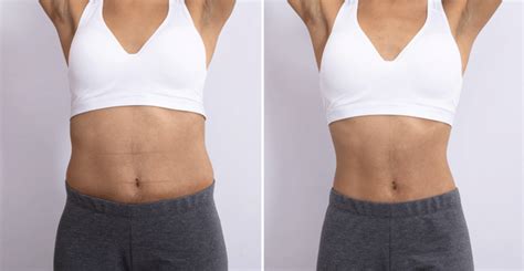 Hifu Before And After Photos London Premier Laser And Skin Clinic