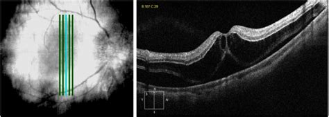 Macular OCT At 24h After Cataract Surgery Showing Macular Thickening Download Scientific
