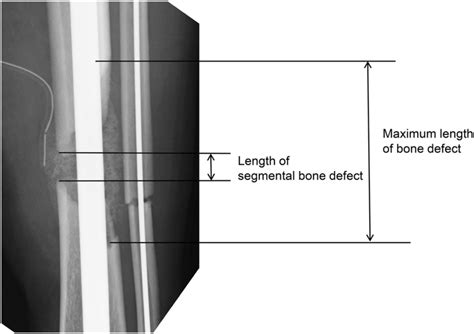 segmental bone defect the length of the bone defect was calculated