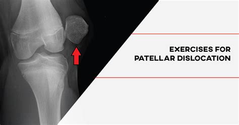 Exercises For Patellar Dislocation [p]rehab