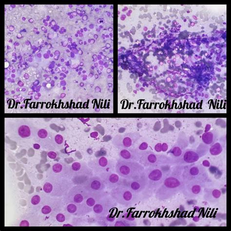 Farrokhshad Nili On Linkedin Thyroid Nodule Aspiration 35 Yo Female