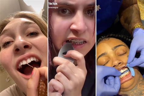 Removing Braces With A Spoon Is A Dangerous Diy Trend On Tiktok Seemayo