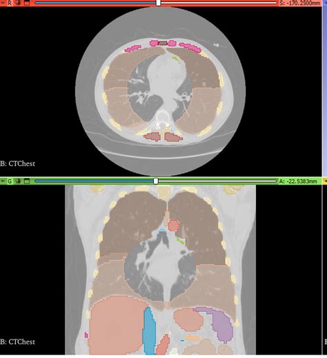 hole in the segmentation v2 · issue 194 · wasserth totalsegmentator · github