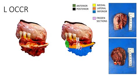 Enhanced Communication Of Tumor Margins Using 3d Scanning And Mapping