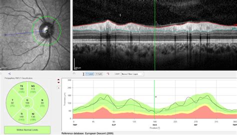 Graves Ophthalmopathy A Neglected Comorbidity Of Graves Disease A