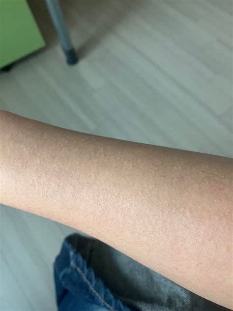 햇빛 알레르기 지식in