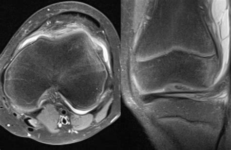 Transient Patellar Dislocation