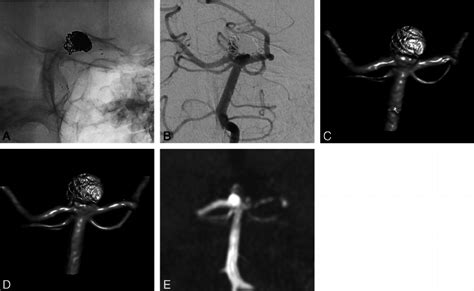 Native A And Dsa Images B After Stent Assisted Coil Download Scientific Diagram