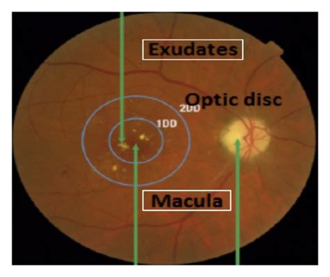 Macula Exudates And Optic Disc In Fundus Image Download Scientific