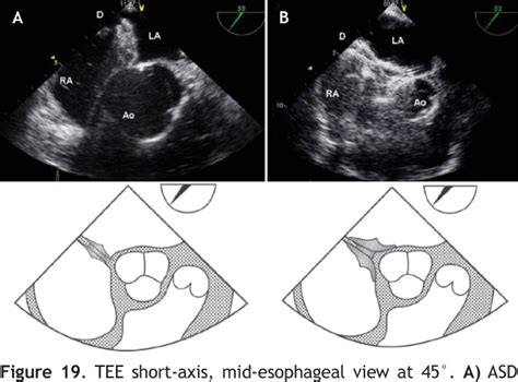 Figure 10 From Multiplanar Transesophageal Echocardiography For The