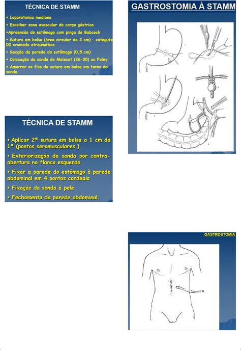 Gastrostomia E Jejunostomia Cirurgia 60 Off