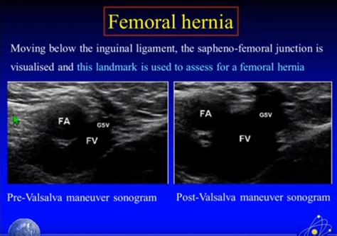 Femoral Hernia Ultrasound
