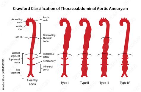 Crawford Classification Of Thoracoabdominal Aortic Aneurysms Healthy