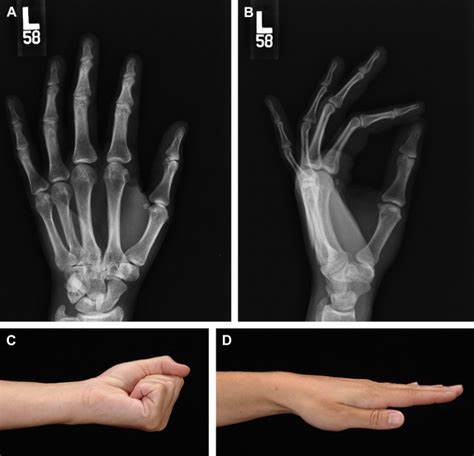 Non Surgical Management Of Metacarpal Fractures Plastic Surgery Key