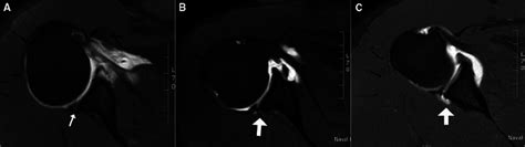 A Magnetic Resonance Arthrogram Depicting A Posterior Shoulder Labral Download Scientific