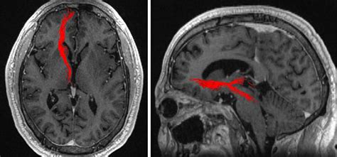 Orbitofrontal Cortex Mri