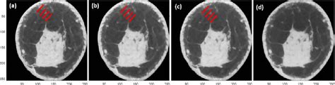 Figure 3 From Cone Beam Breast Computed Tomography Using Ultra Fast Image Reconstruction With