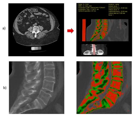 A New Opportunistic Bone Density Screening Method Based On Colored Ct