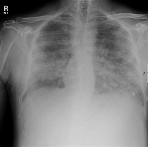 Southwest Journal Of Pulmonary Critical Care And Sleep Imaging