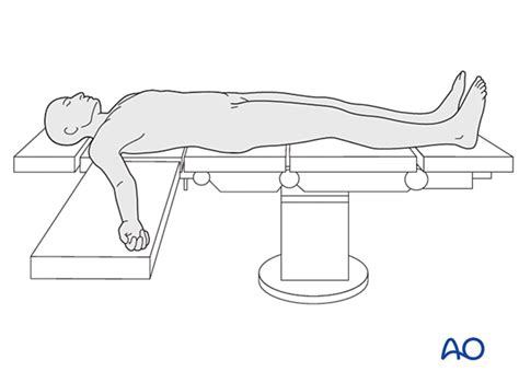 Proximal Tibia Replacement For Fracture Around A Loose Tibial Component With Good Bone Stock
