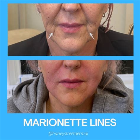 Before And After Harley Street Dermal