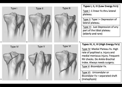 Tibial Plateau Fracture Classification