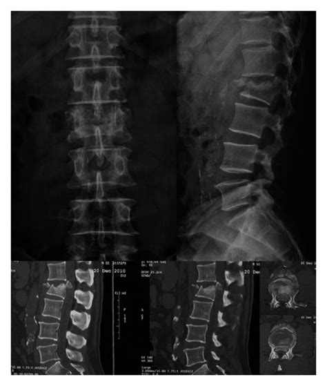 X Ray And CT Scan Showing A Burst Fracture On L2 Vertebra With A Download Scientific Diagram