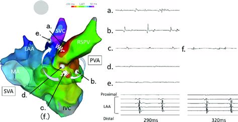 Biatrial Activation Map From Posterior Cranial View And Local