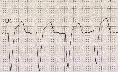 Left Bundle Branch Block INA ECG