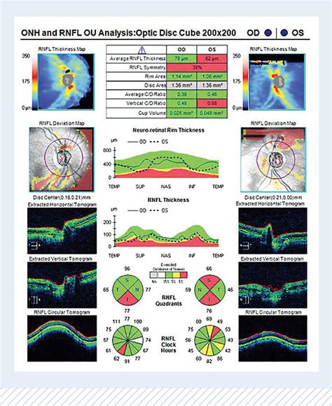Clinical Glaucoma Optometric Management