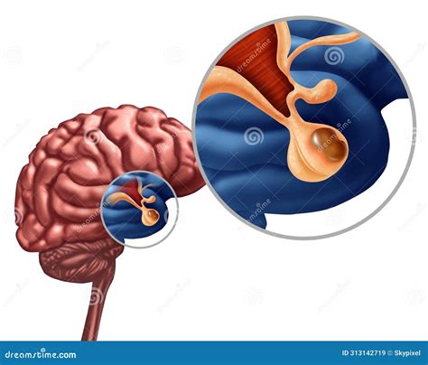 Pituitary Adenoma Benign Tumor Stock Image 313142719