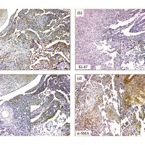 Clinical Appearance Of The Submucosal Nodule On The Lower Labial Mucosa Download Scientific